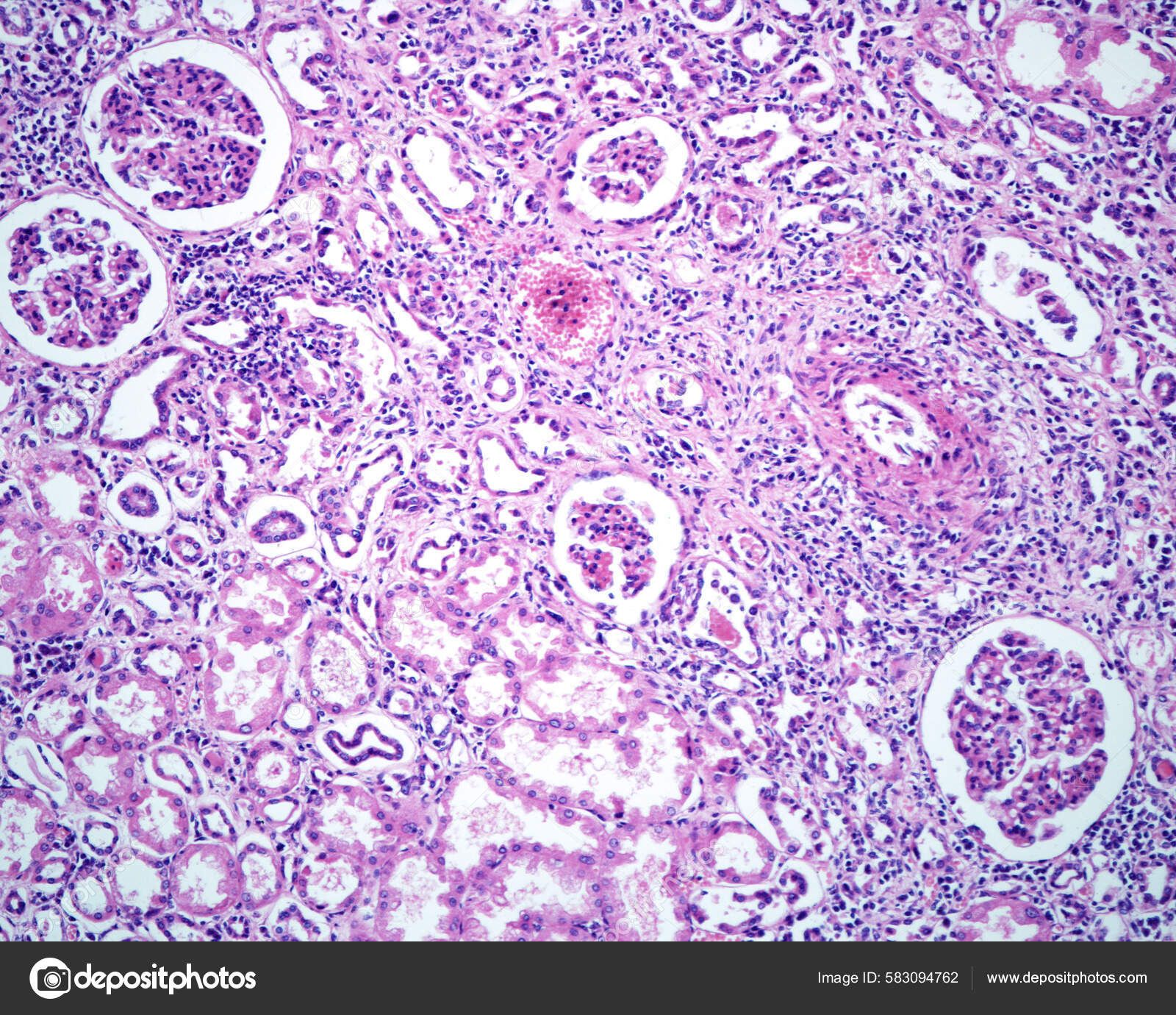 Polyarteritis Nodosa Pan Systemic Necrotizing Inflammation Blood ...