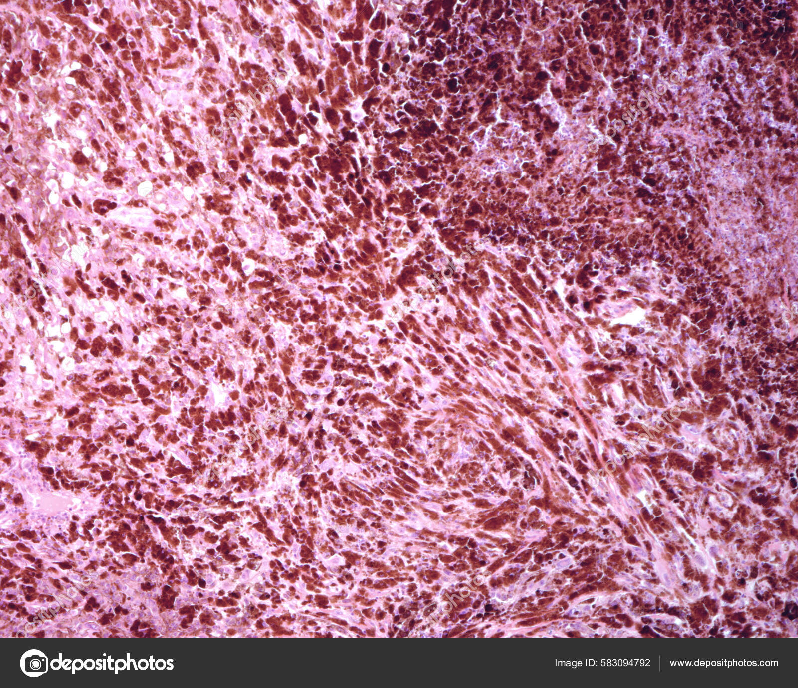 Human Lymph Node Metastasis Malignant Melanoma Normal Lymphoid Tissue ...