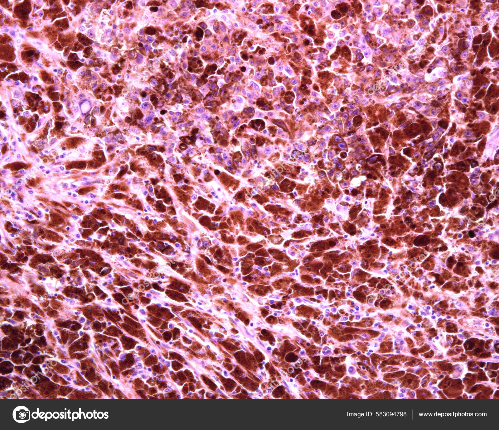 Human Lymph Node Metastasis Malignant Melanoma Normal Lymphoid Tissue ...