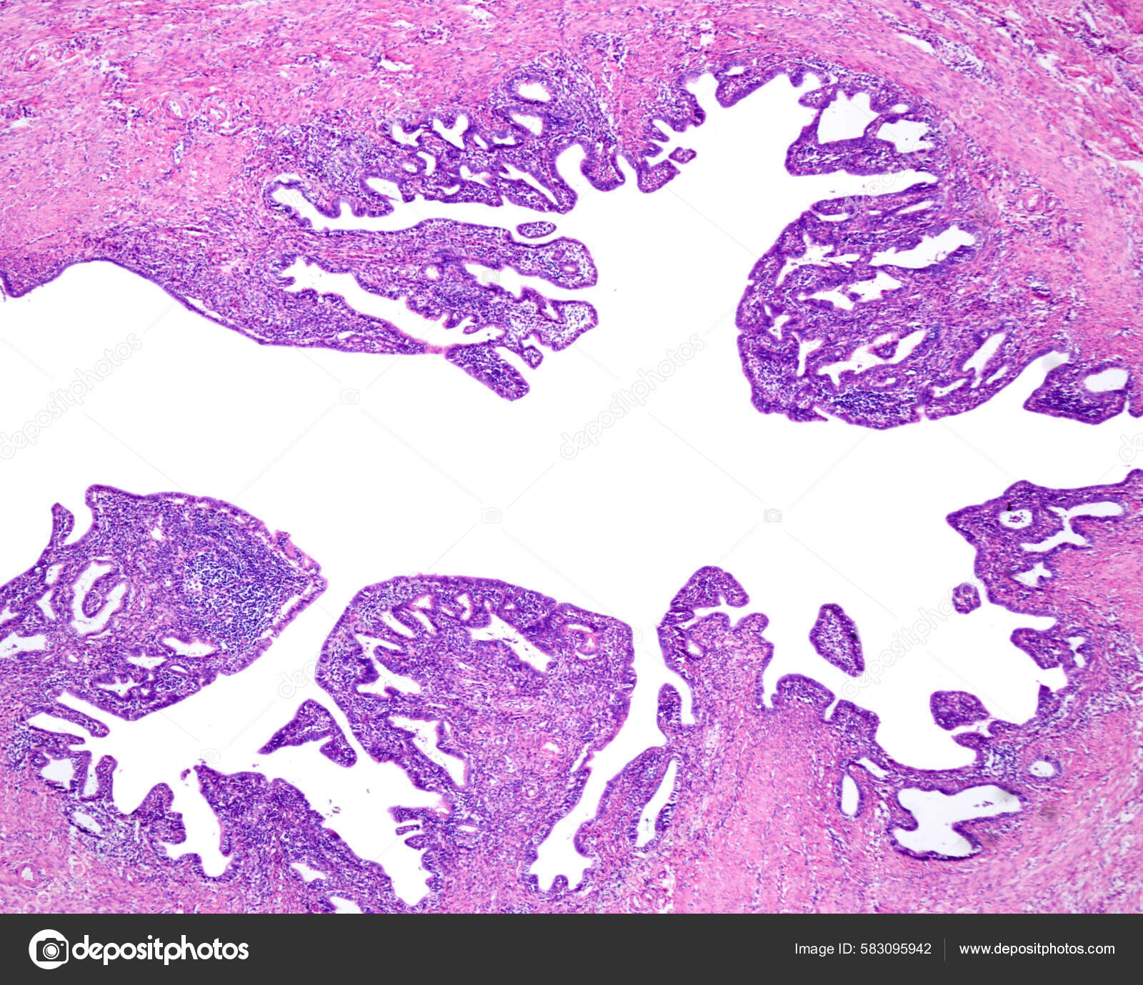 Human Fallopian Tube Affected Chronic Salpingitis Fallopian Tube Lumen ...