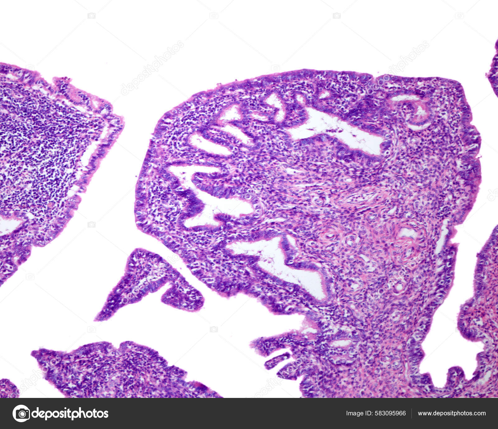 Human Fallopian Tube Affected Chronic Salpingitis Mucosal Folds Widened ...