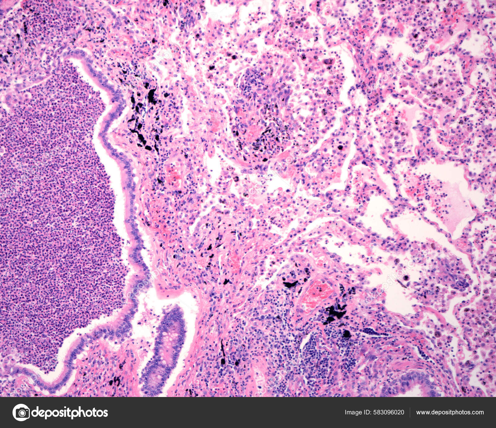 Human Lung Affected Acute Bronchopneumonia Commonly Hospital Acquired ...