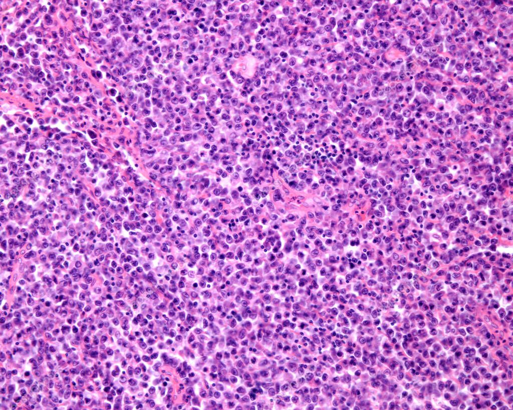 Reticulosarcoma. Light micrograph from a lymph node in a case of ...
