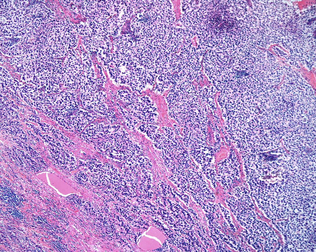 Light microscope micrograph of a seminoma, a germ cell malignant tumour ...