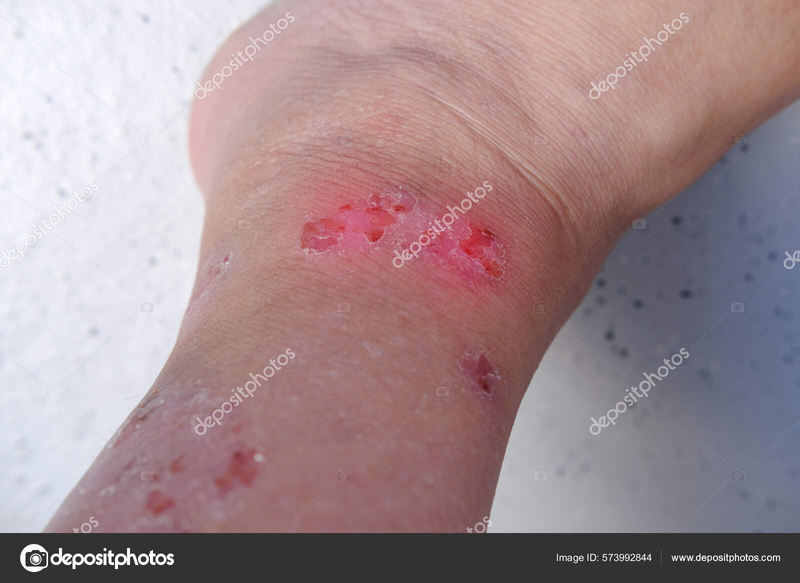 Close Female Leg Healing Wound Lower Leg Scars Adult Female — Stock ...