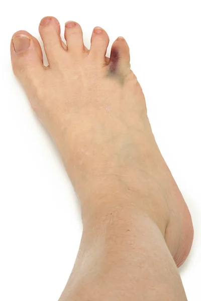 Pinky toe pain Stock Photos, Royalty Free Pinky toe pain Images ...