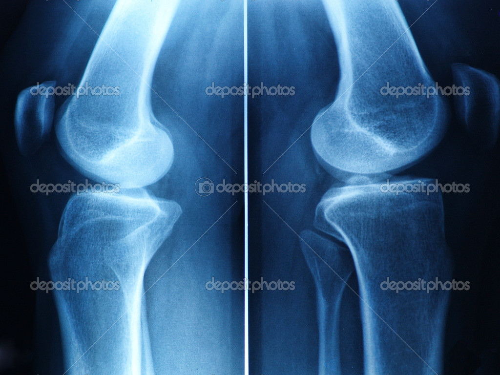 Knee x-ray Stock Photo by ©Bunyos30 18727897