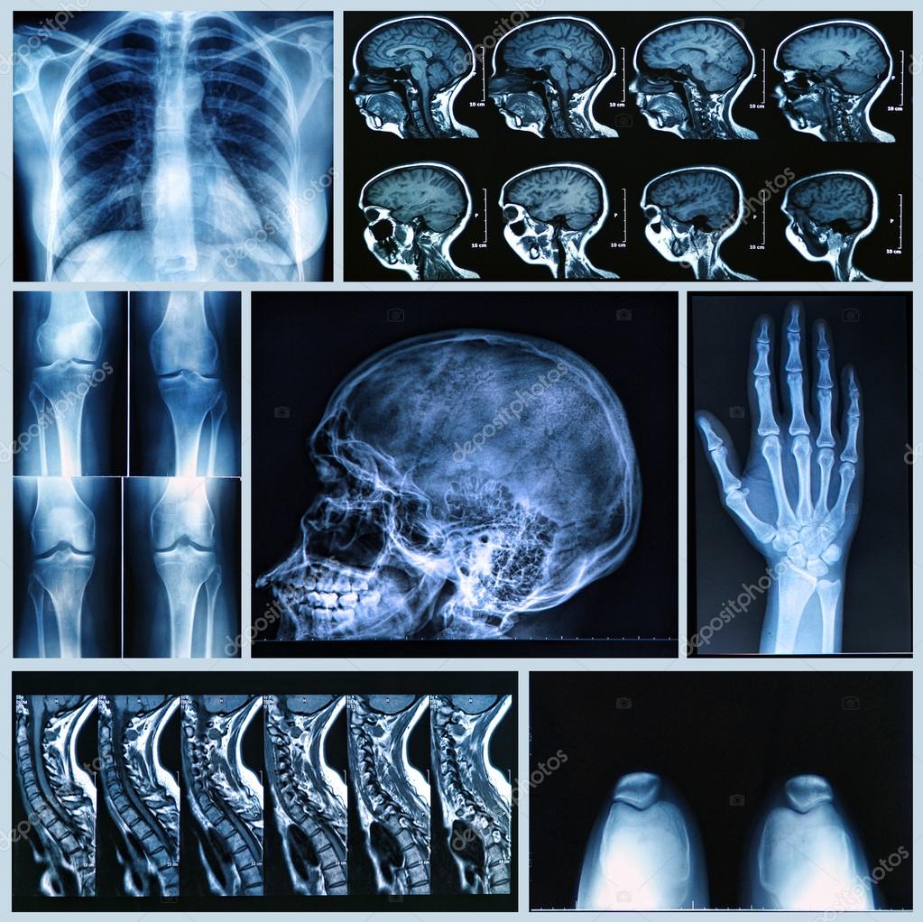 Radiography of Human Bones — Stock Photo © Bunyos30 #25928955