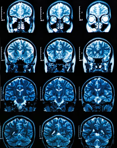 MRI Brain Scan - Stock Image - Everypixel