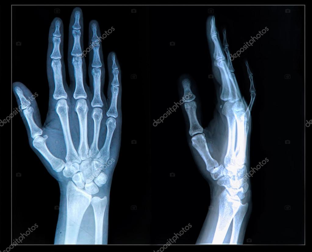 Xray Hand