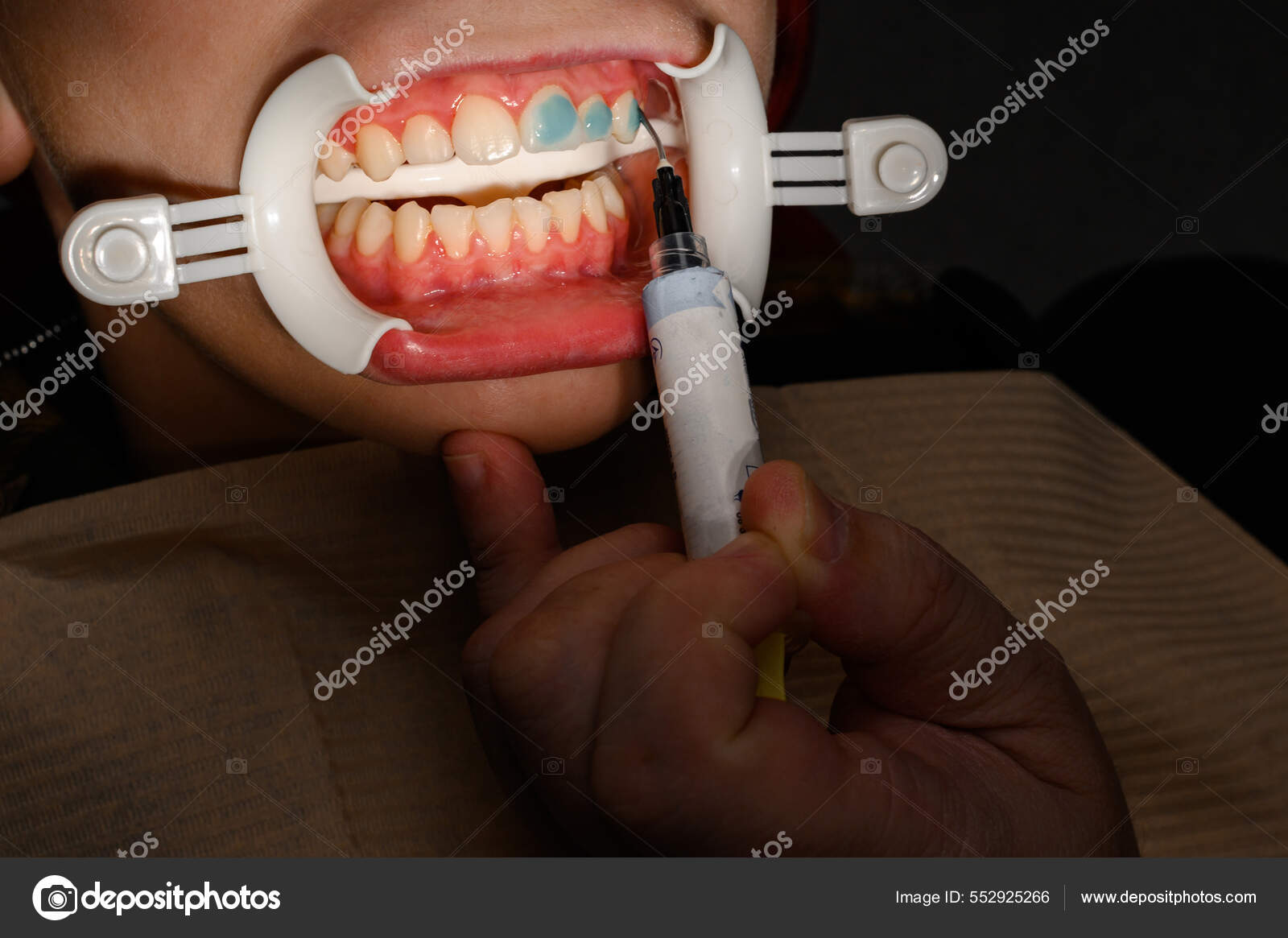 Plastic Retractor Lip Augmentation Mouth Dental Procedure Retractor ...