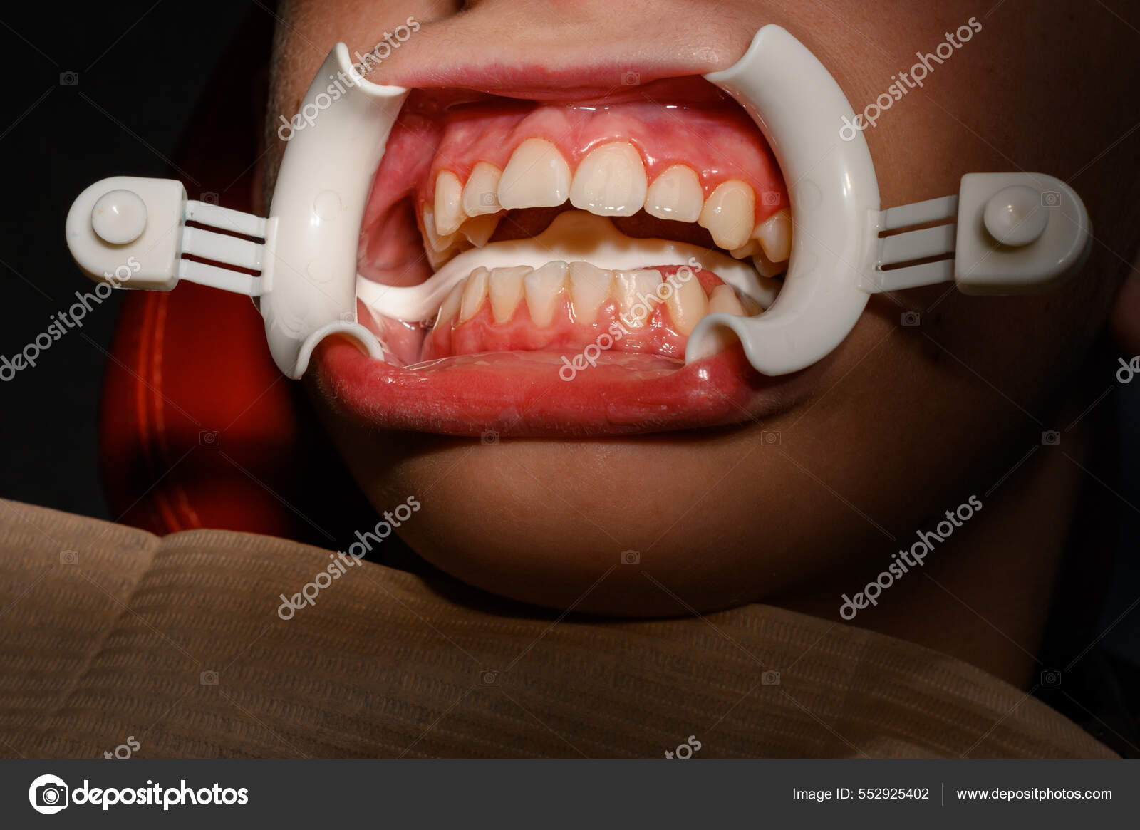 Plastic Retractor Lip Augmentation Mouth Dental Procedure Retractor ...