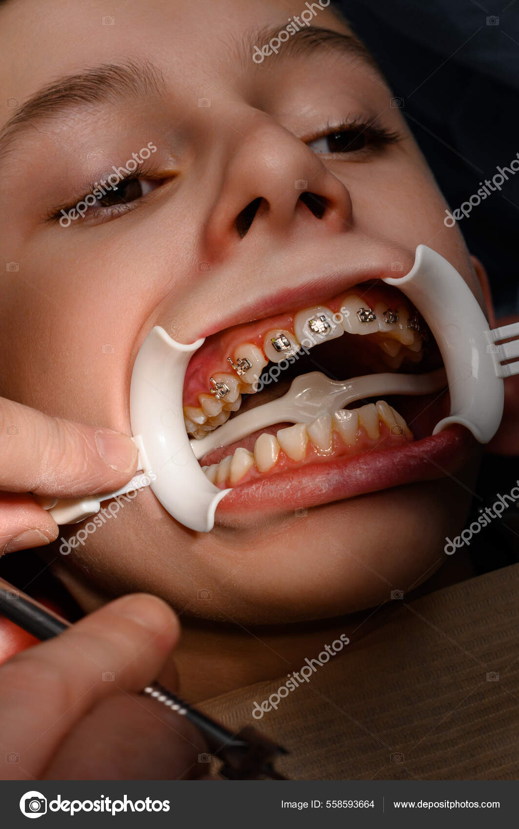 White Retractor Lips Installation Metal Braces Upper Teeth Teenager ...