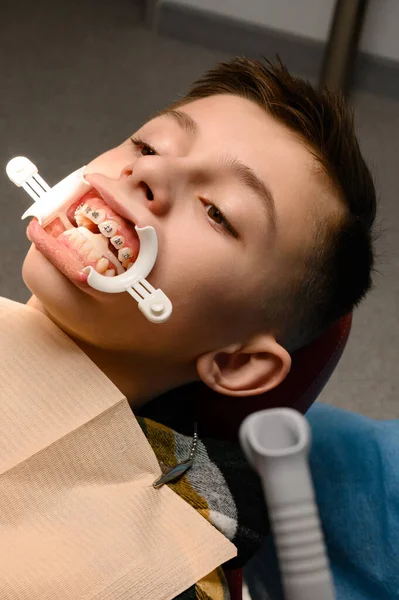 White Retractor Lips Installation Metal Braces Upper Teeth Teenager ...