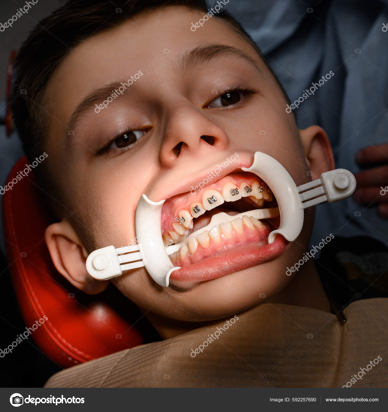 White Retractor Lips Installation Metal Braces Upper Teeth Teenager ...