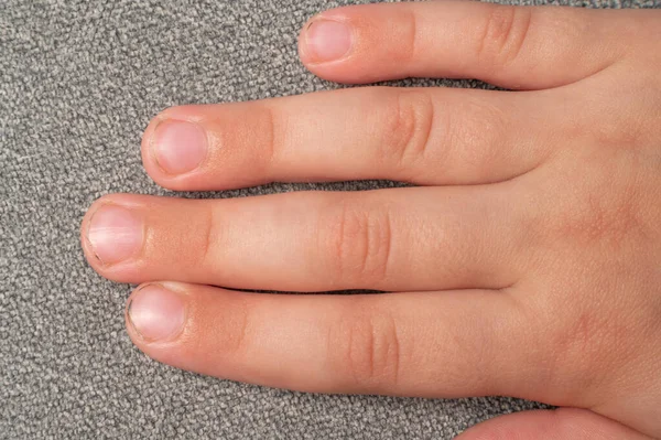 Dirty Sloppily Trimmed Child's Fingernails Fingers Toenails Close ...