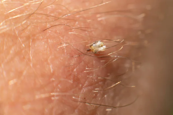 Ticks human skin Stock Photos, Royalty Free Ticks human skin Images ...