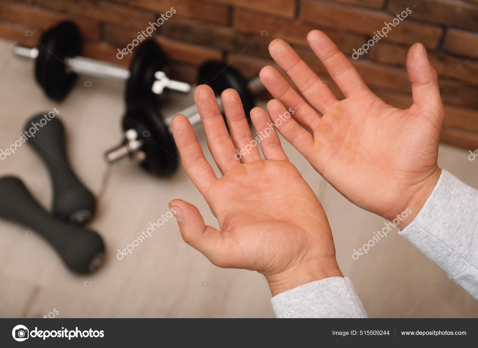 Man Suffering Calluses Hands Indoors Closeup Stock Photo by ©NewAfrica ...