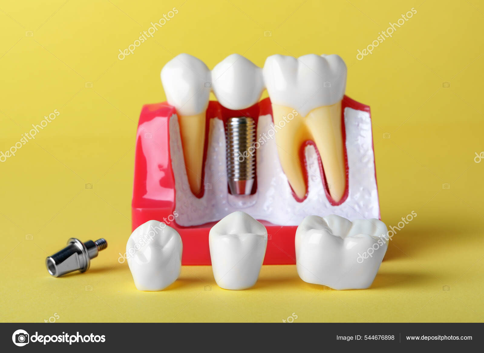 Educational Model Gum Post Crown Dental Implant Teeth Yellow Background ...