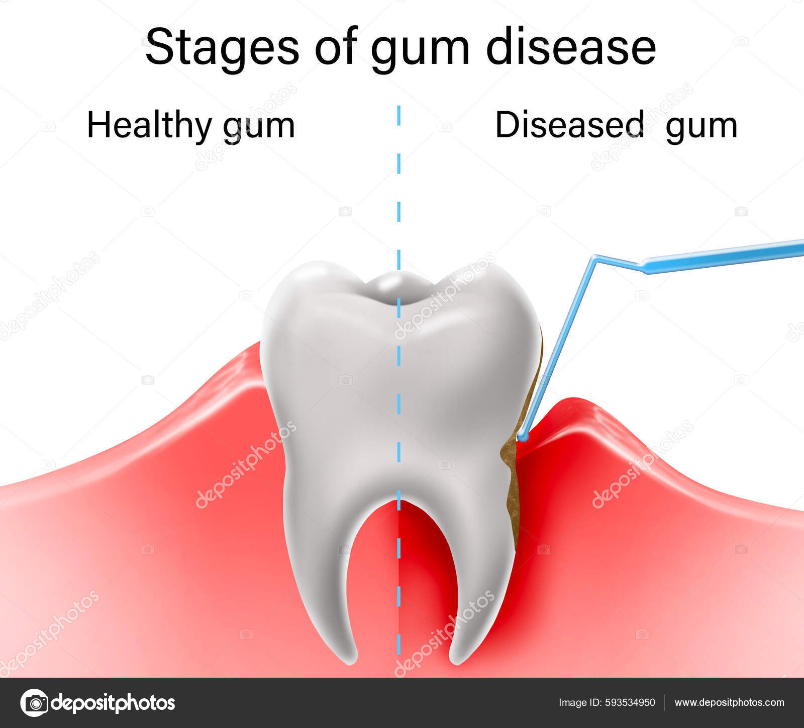 Collage Illustrations Healthy Tooth Gum Diseased Ones Gingivitis ...