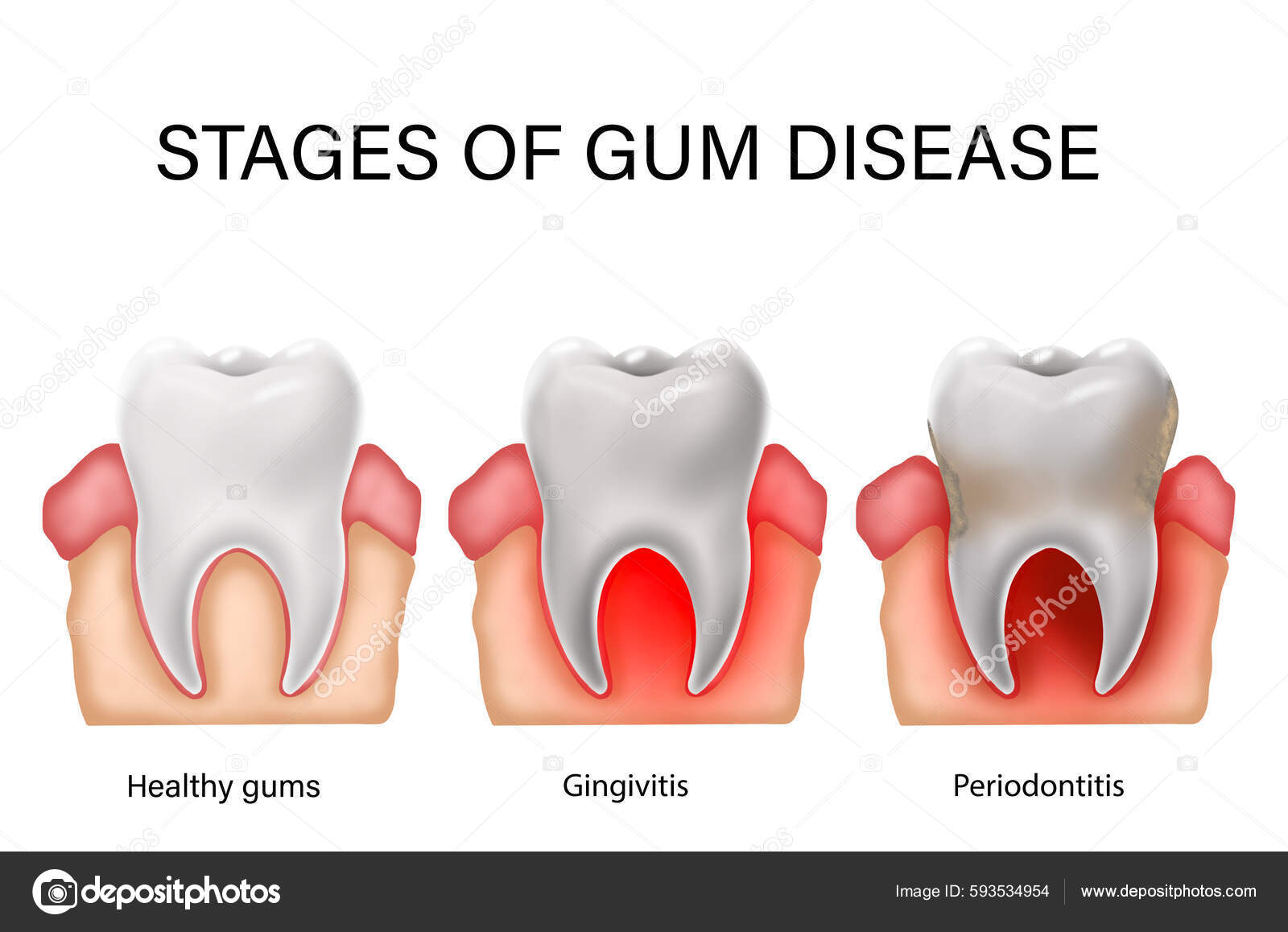 Collage Illustrations Healthy Tooth Gum Infected Ones Showing Stages ...