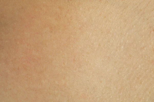 White spot skin Stock Photos, Royalty Free White spot skin Images ...