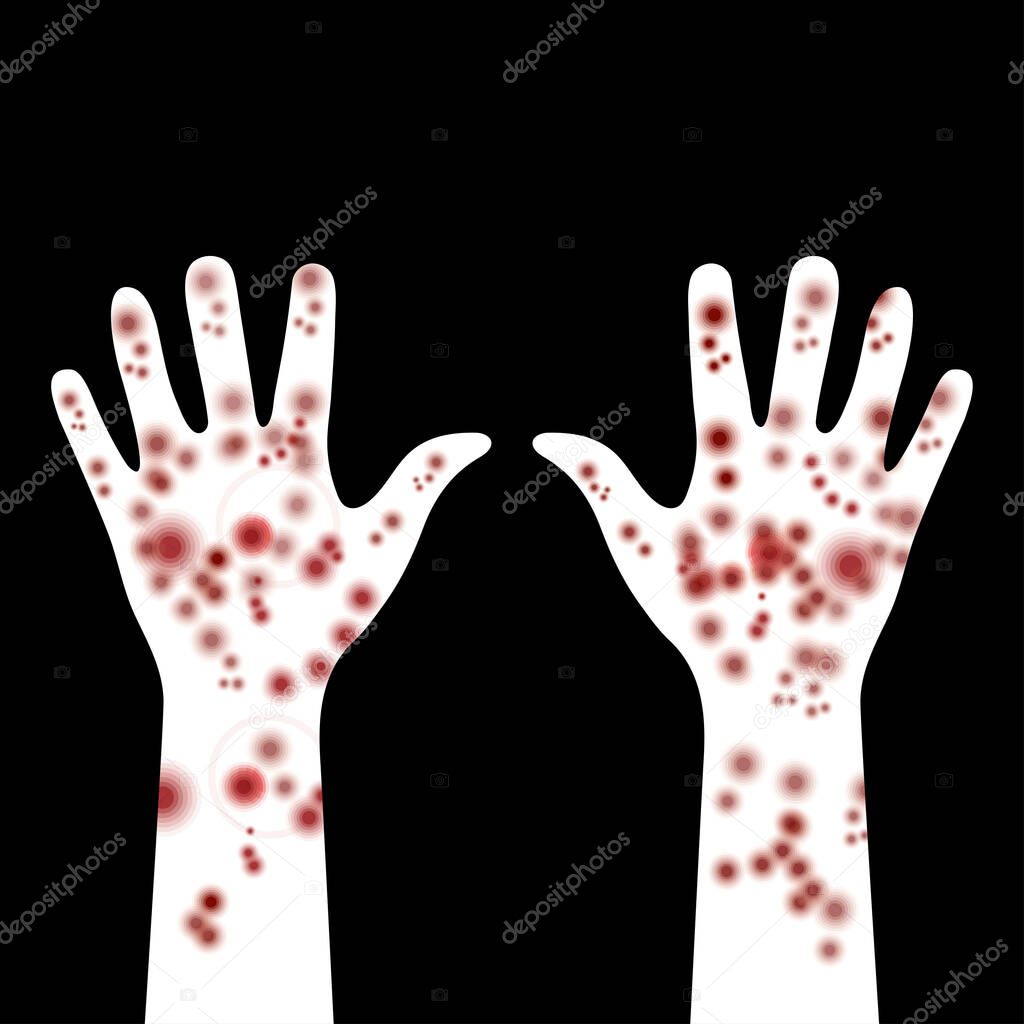Erupción dolorosa en las manos. Manchas en las manos con tono de piel blanca. Síntomas del ...