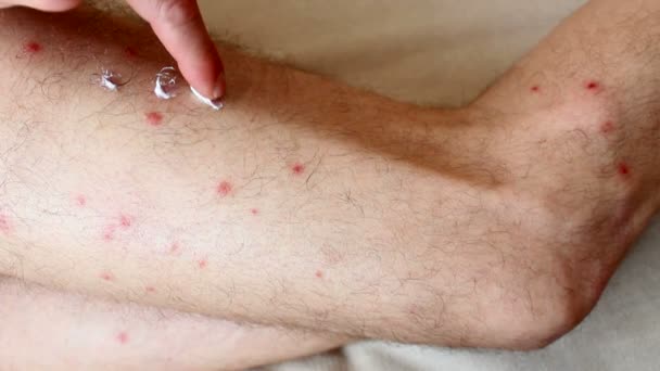 Irritant contact dermatitis at man leg, close up — Stock Video ...