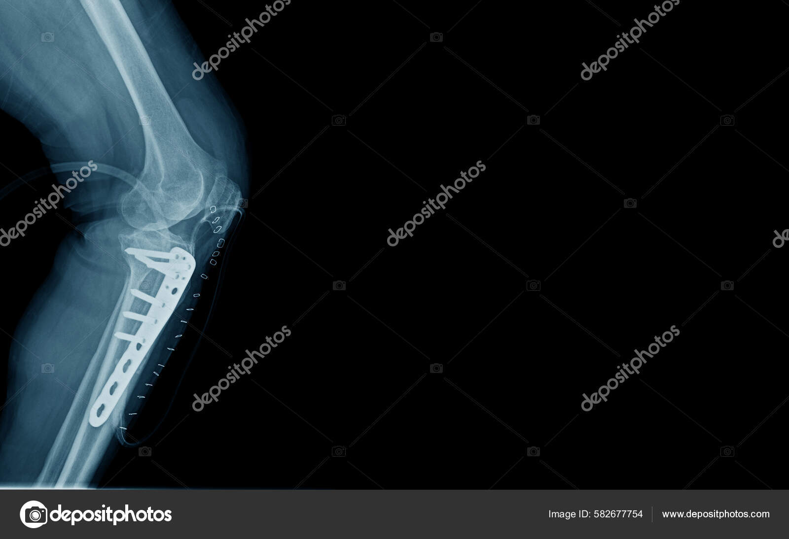Anatomía De La Tibia Proximal