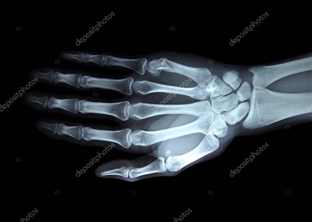 X-ray right hand Stock Photo by ©fotographic1980 13881204