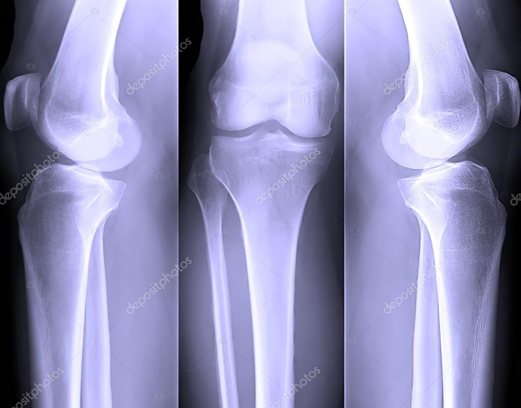 Knee x-ray Stock Photo by ©Flik47 12541337