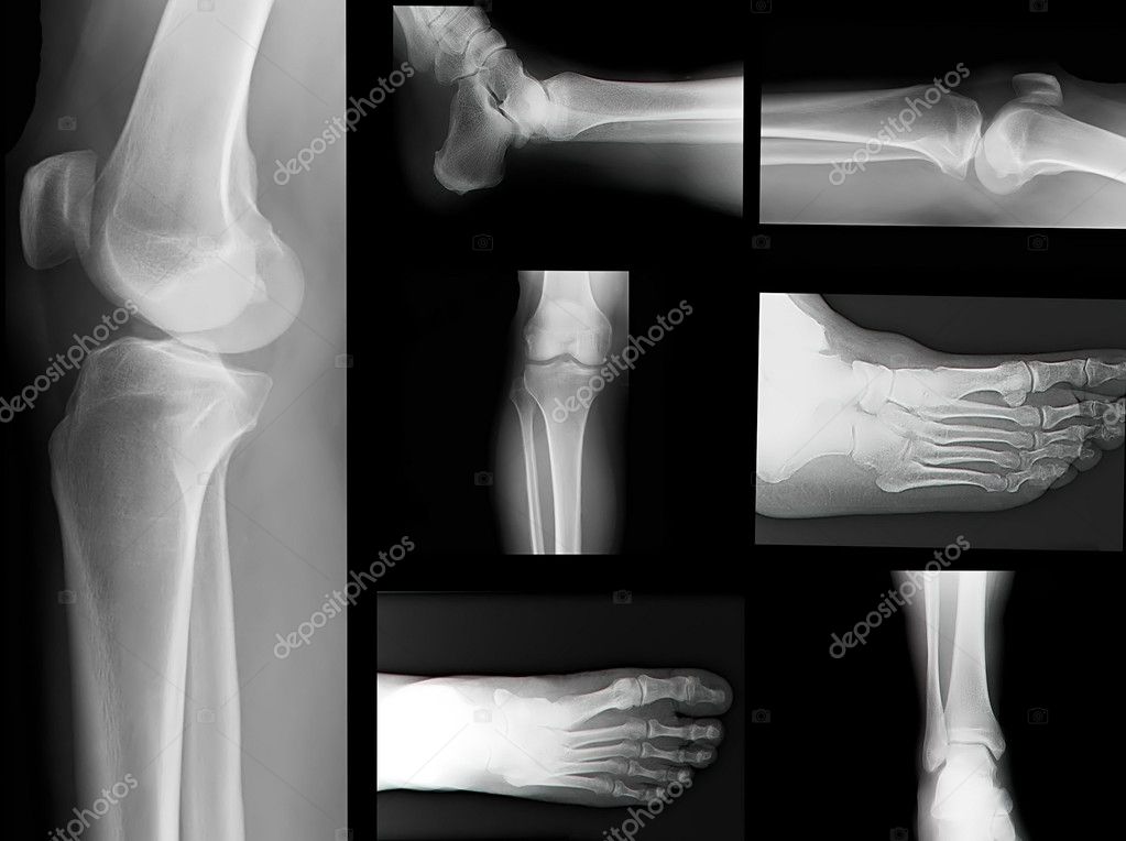 X Ray Leg X-ray of human legs | Stock Photo | Colourbox