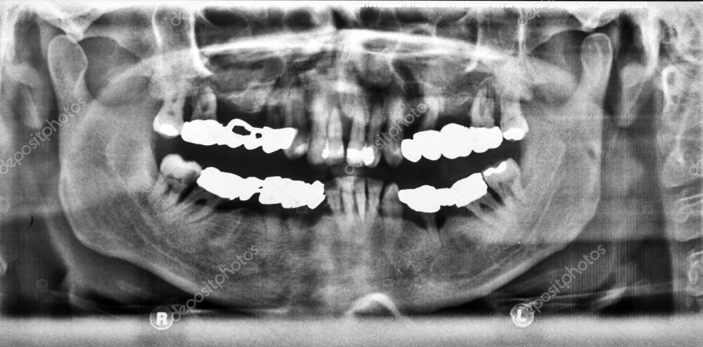 Panoramic x-ray image of teeth — Stock Photo © chatsimo #24021019