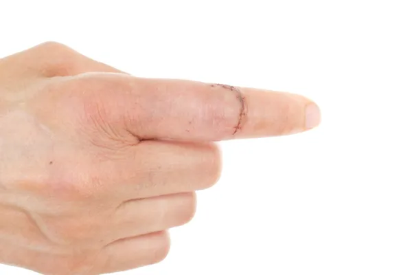 Scar treatment Stock Photos, Royalty Free Scar treatment Images ...