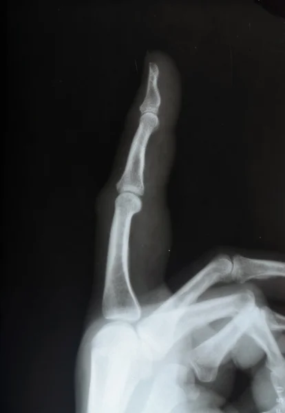 Dislocated finger, two projections, X-ray. ring on the finger — Stock ...