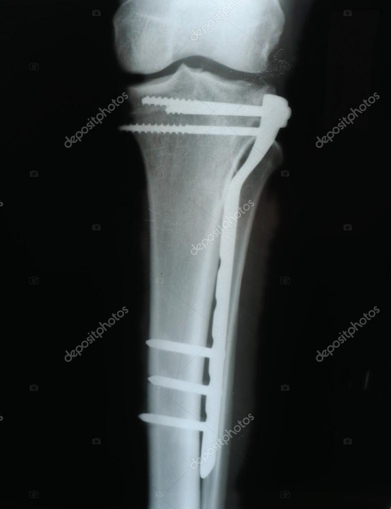 tornillos y placas para conectar la fractura de la tibia, rayos X 2022