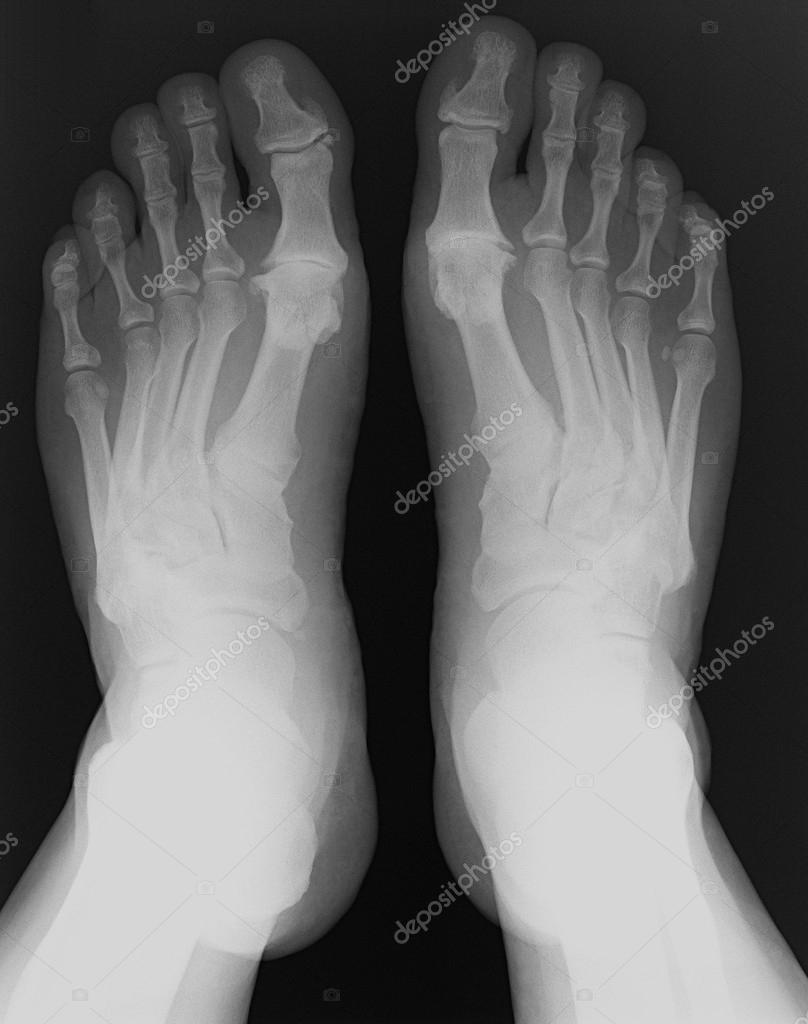 RTG stopy — Zdjęcie stockowe © smuki #12721652