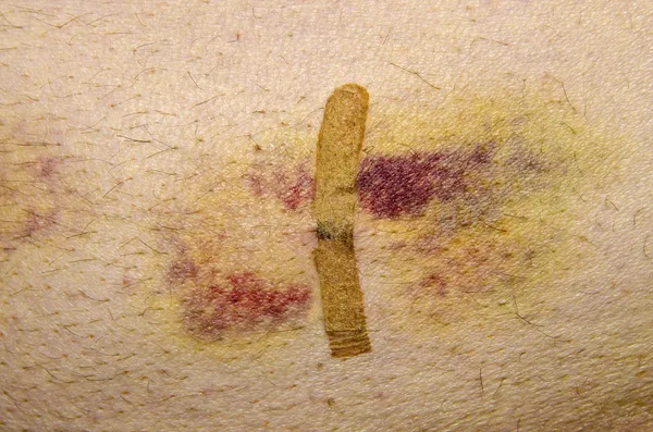 Surgical plaster Pictures, Surgical plaster Stock Photos & Images ...