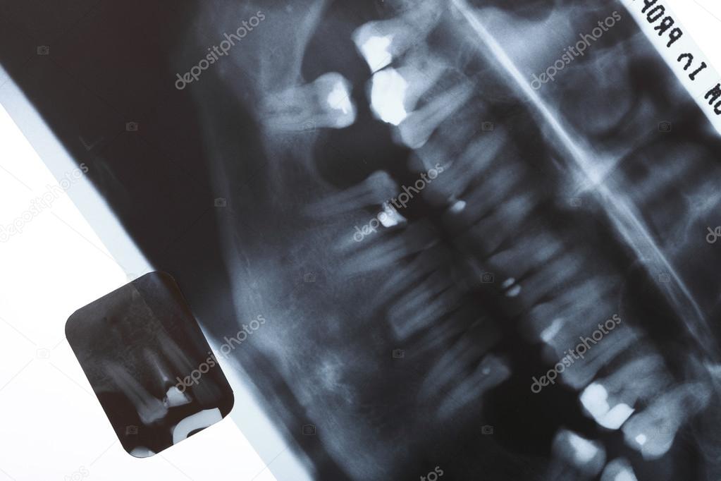 X-ray scan of humans teeth Stock Photo by ©Voyagerix 30172547