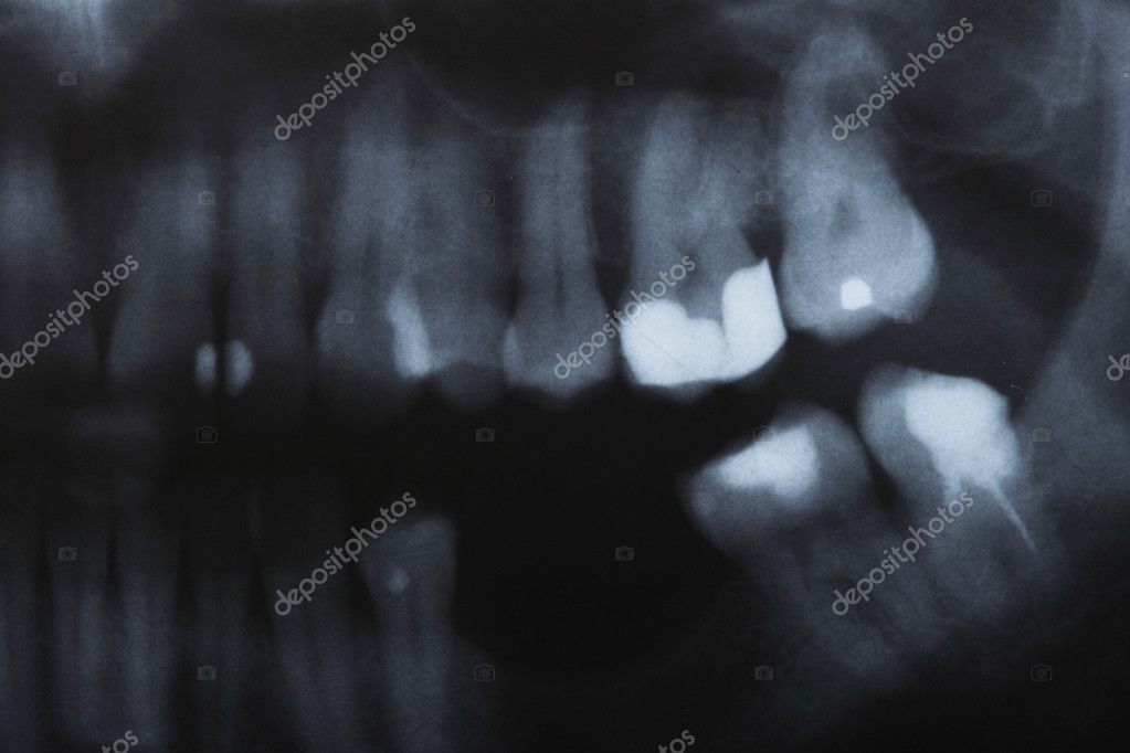 X-ray scan of humans teeth Stock Photo by ©Voyagerix 30242143