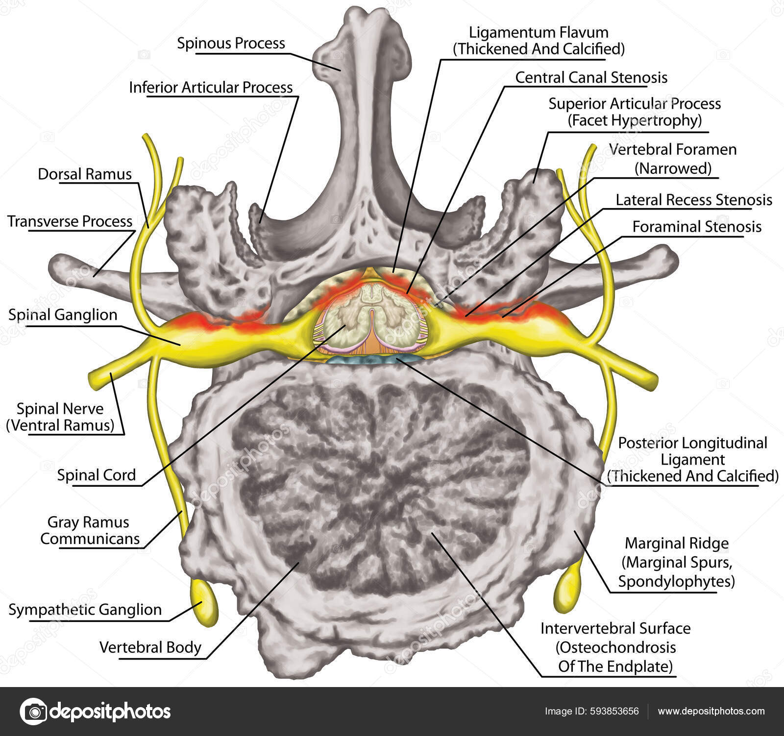 Central Lateral Stenosis Second Lumbar Vertebra Nervous System Spinal ...