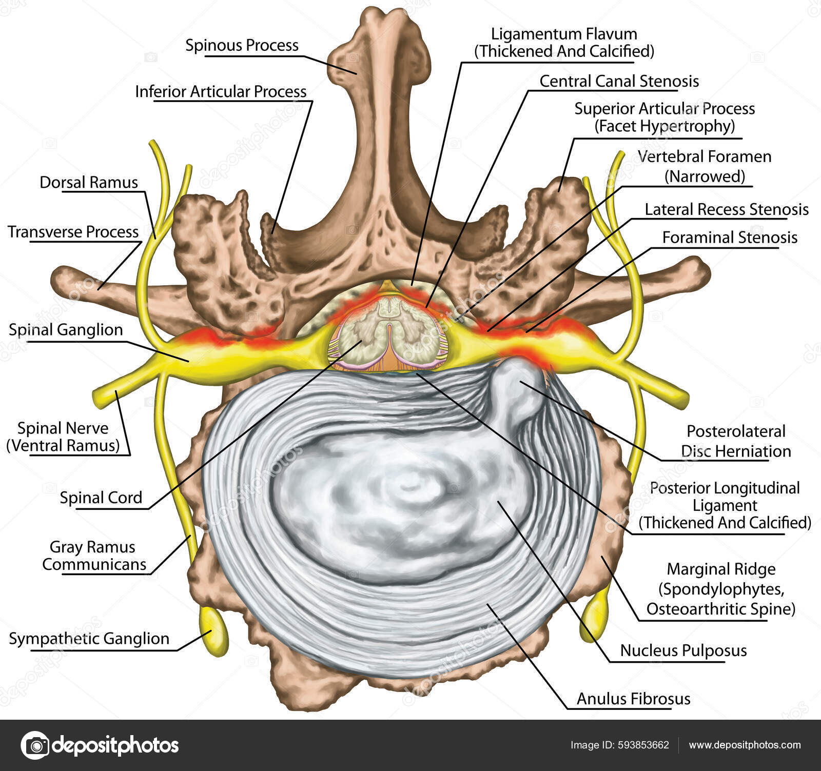 Stenosis Lumbar Disk Herniation Herniated Disc Lumbar Vertebra ... Stenosis Lumbar Disk Herniation Herniated Disc Lumbar Vertebra ...