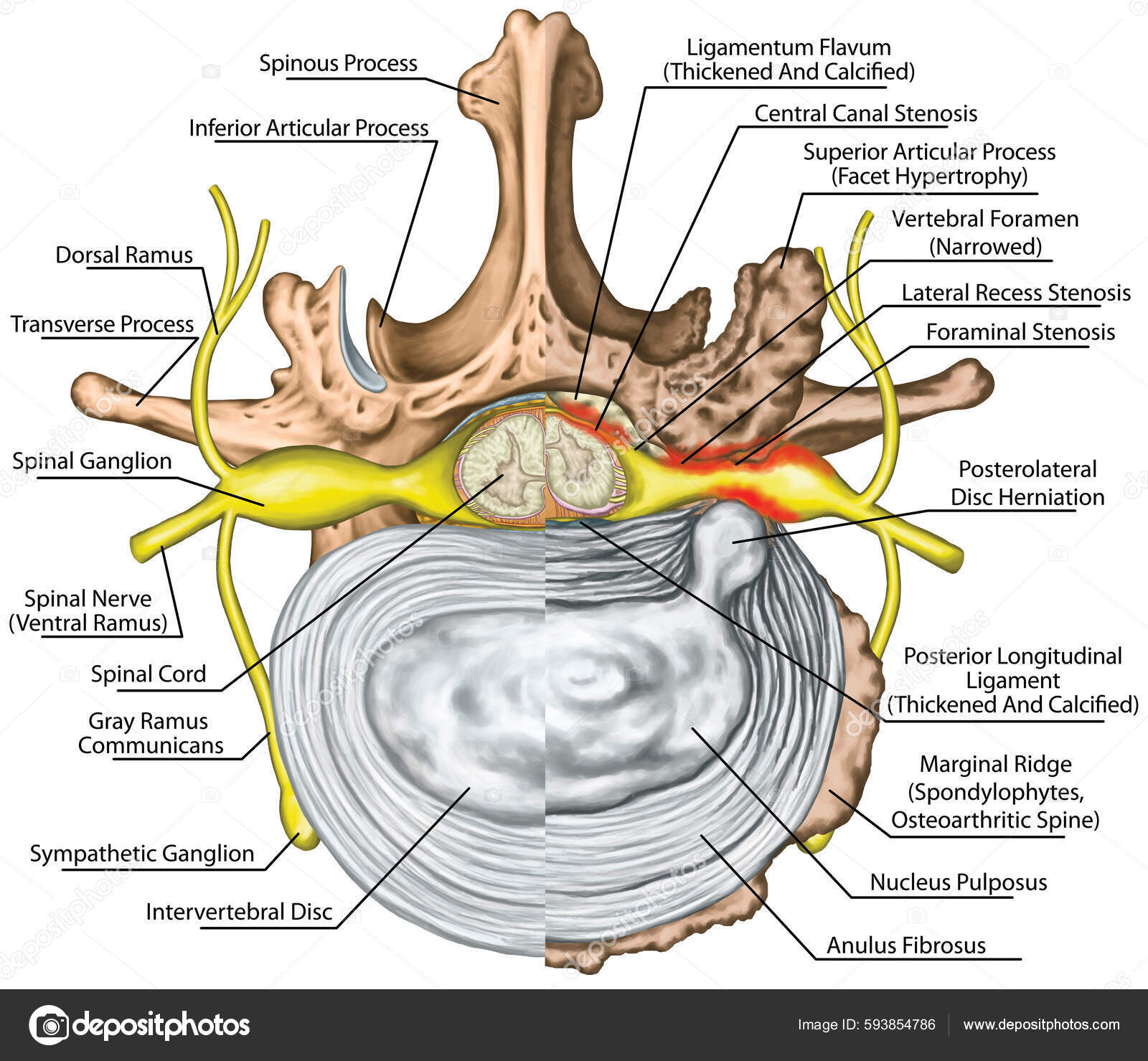 Stenosis Lumbar Disk Herniation Herniated Disc Lumbar Vertebra ...