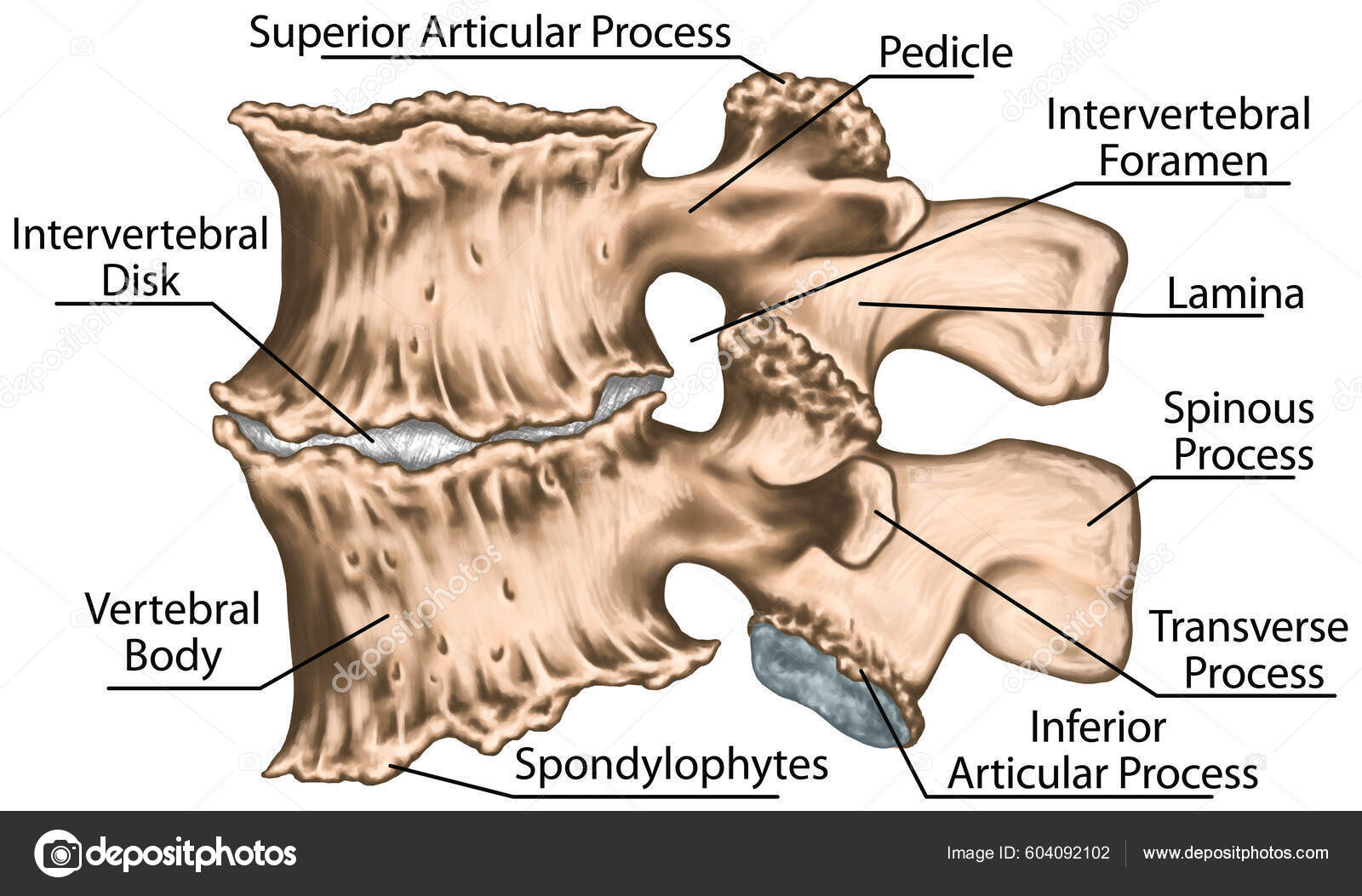 Uncovertebral Osteophytes