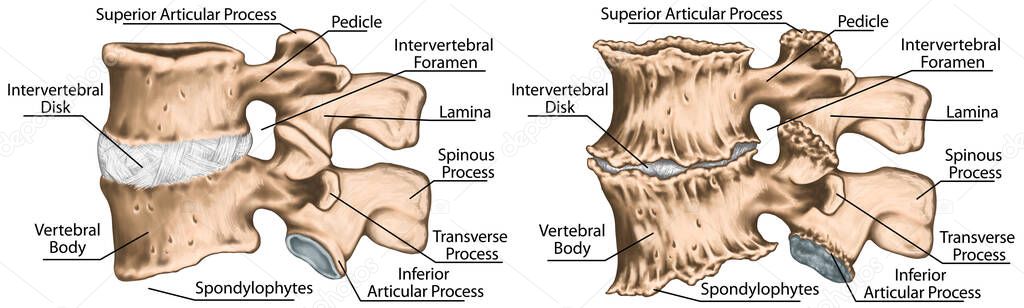 Spondylophytes involving a spinal motion segment, advanced ...