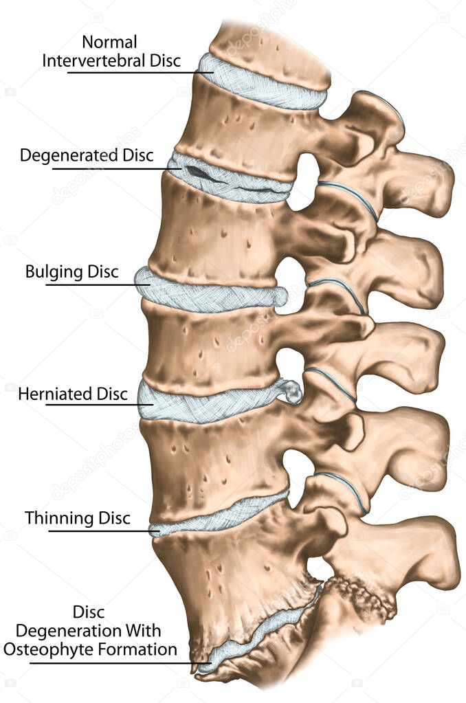 Spine disc problems, degenerative lumbar disc disease, degenerative ...