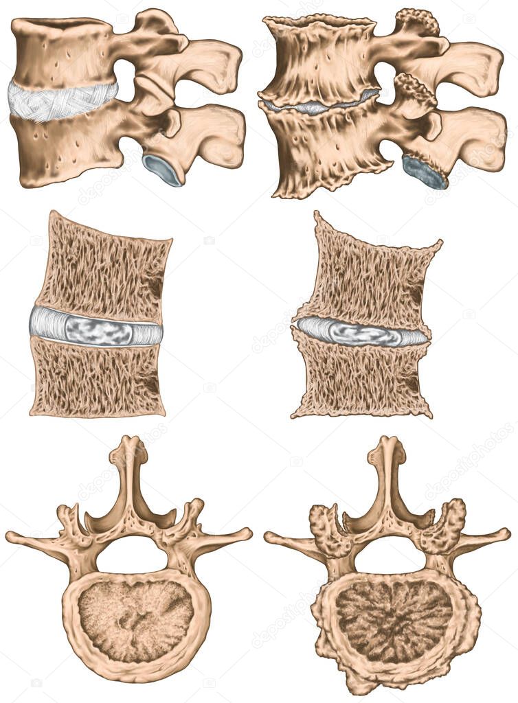 Didactic board, spondylophytes involving a spinal motion segment ...