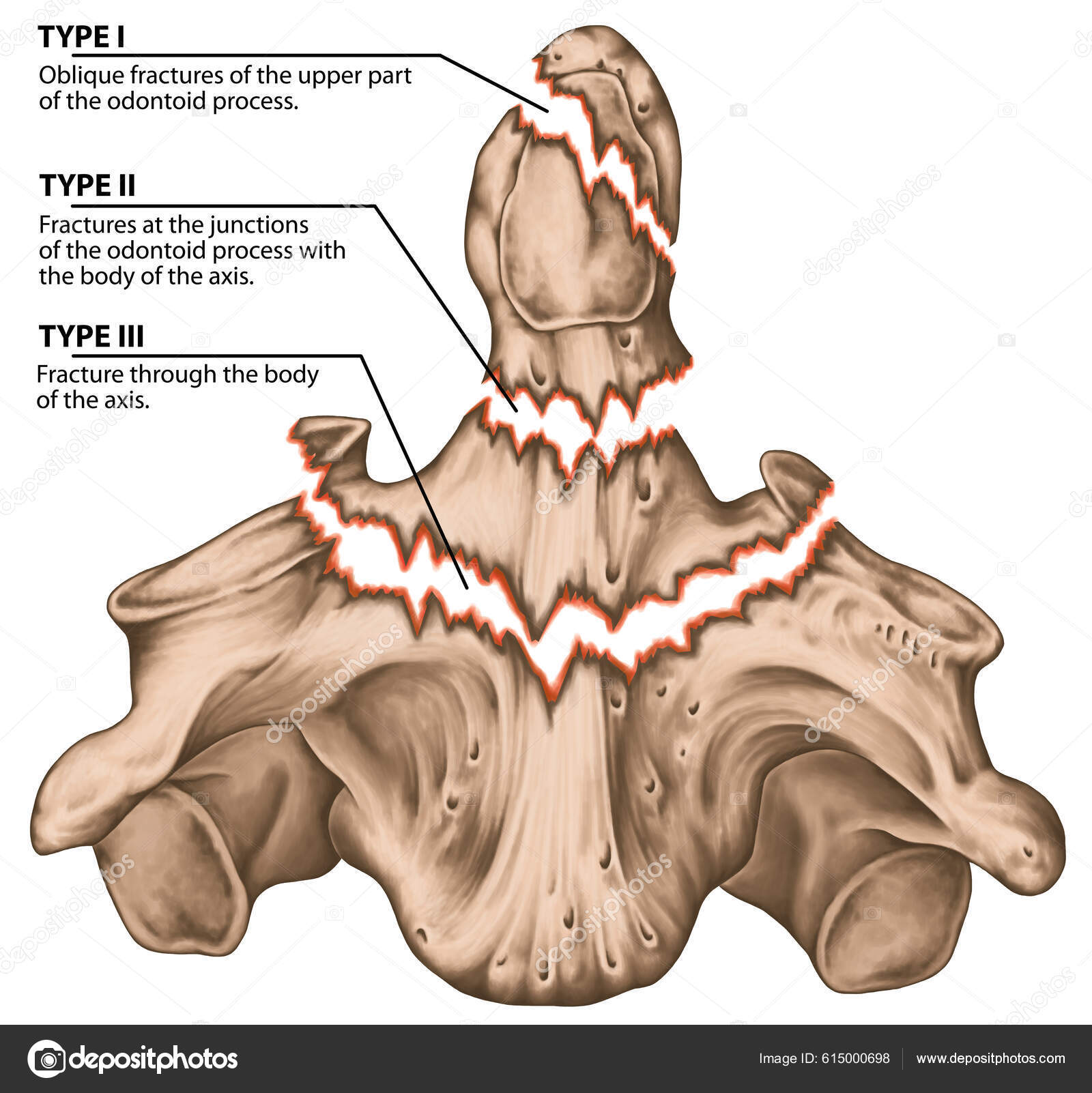 Three Types Odontoid Fractures Fractures Axis Oblique Avulsion ...