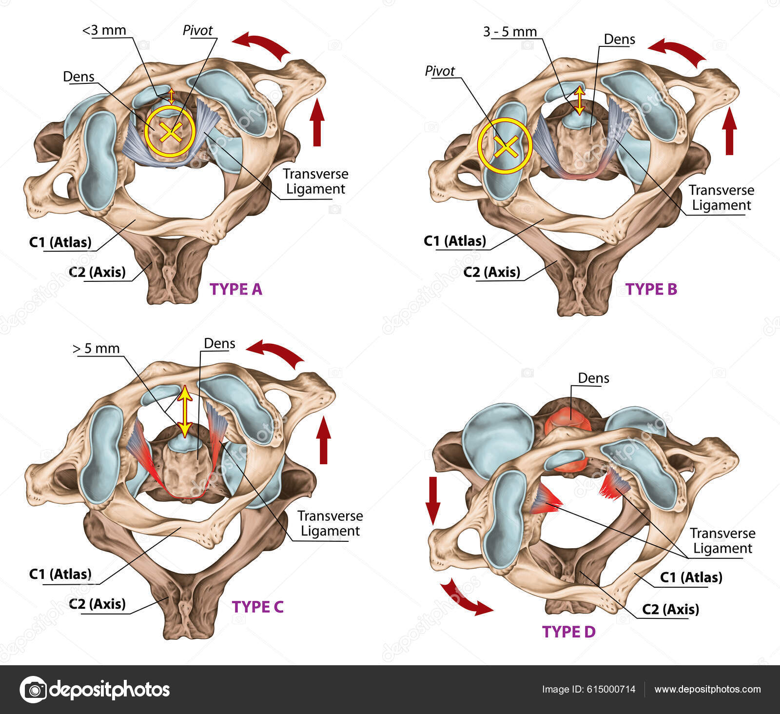 Traumatic Rotatory Displacement Atlas Subluxation Dislocation Four ...