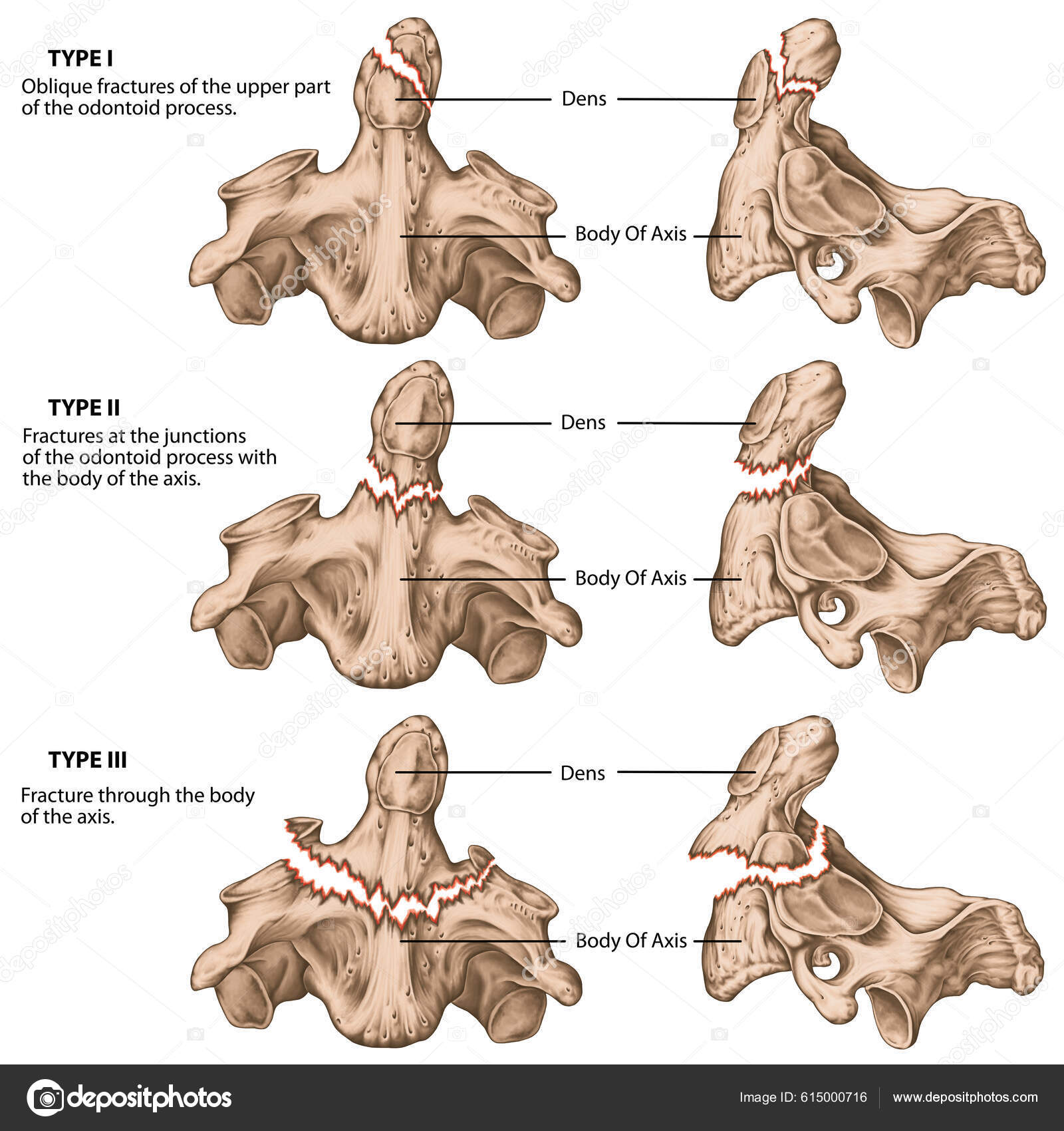 Tres Tipos Fracturas Odontoides Fracturas Del Eje Fracturas Avulsión ...